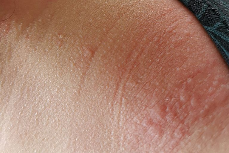 Nesselsucht (Urtikaria) - Privatpraxis für HNO