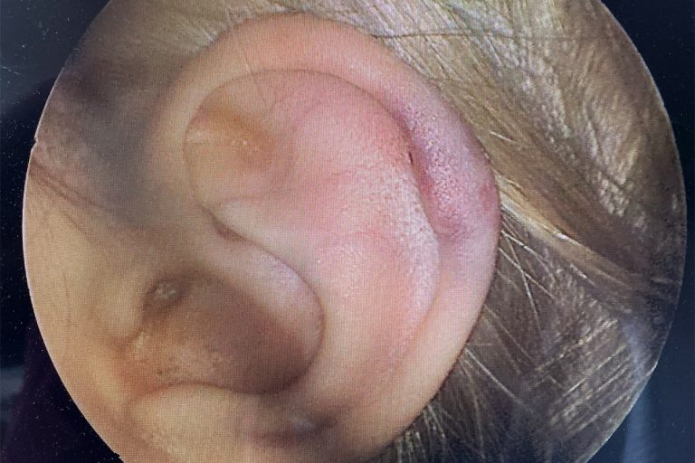 Ohrmuschel-Bluterguss (Othämatom) - Privatpraxis für HNO